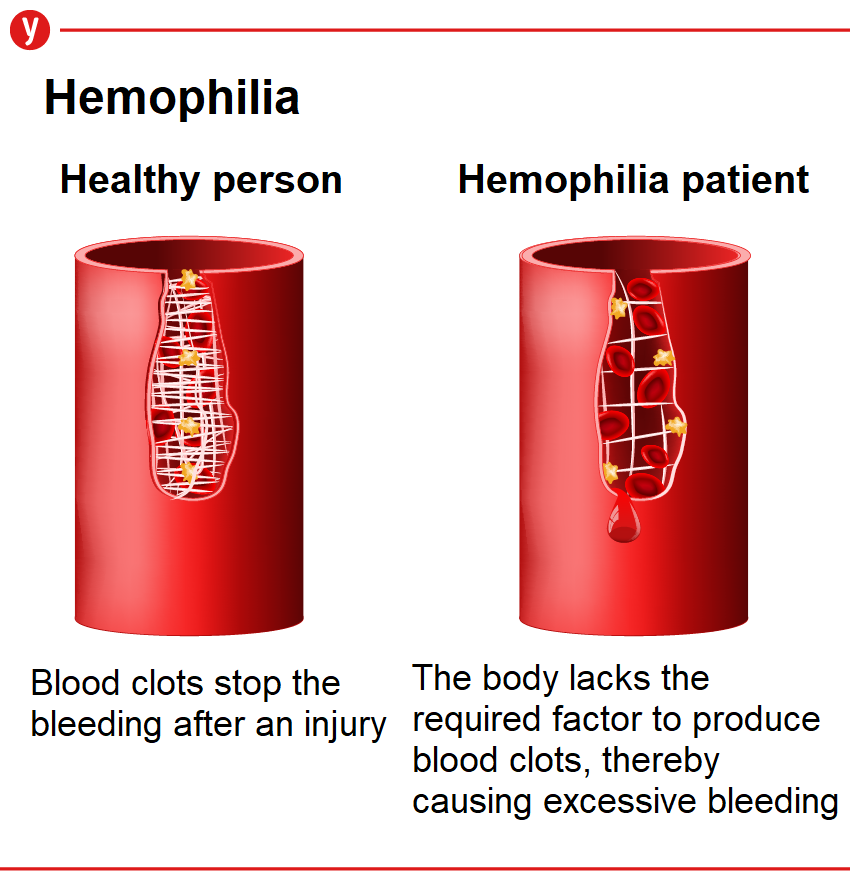 Israelis take part in successful trial to cure hemophilia