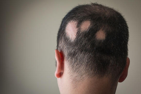 New treatment shows success against spot baldness
