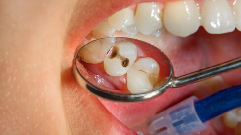 Israeli study finds molecule effective against tooth decay
