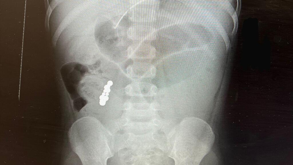 Toddler has part of intestine removed after swallowing magnets