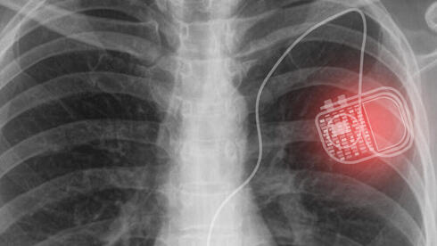 How does Netanyahu's pacemaker work?