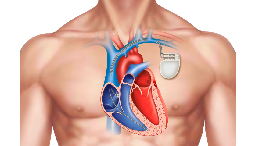 How does Netanyahu's pacemaker work?