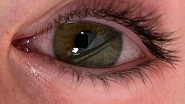 Spring dip leaves two Israeli children with eye leeches