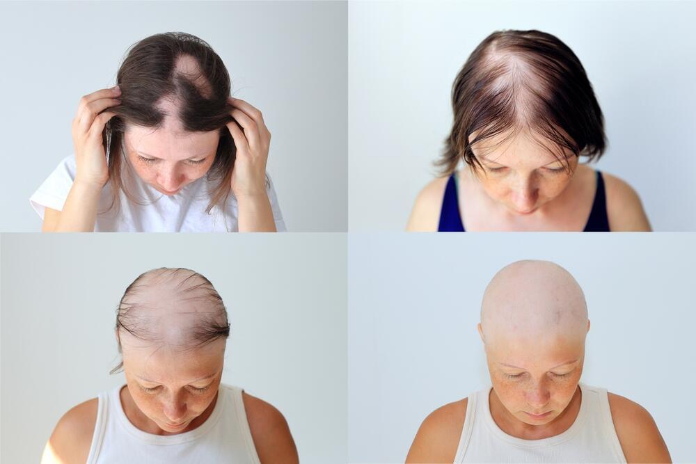 What is alopecia areata, how to cope with it and is there treatment?