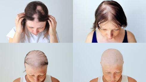 What is alopecia areata, how to cope with it and is there treatment?