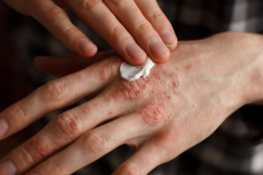 Winter Skin Diseases